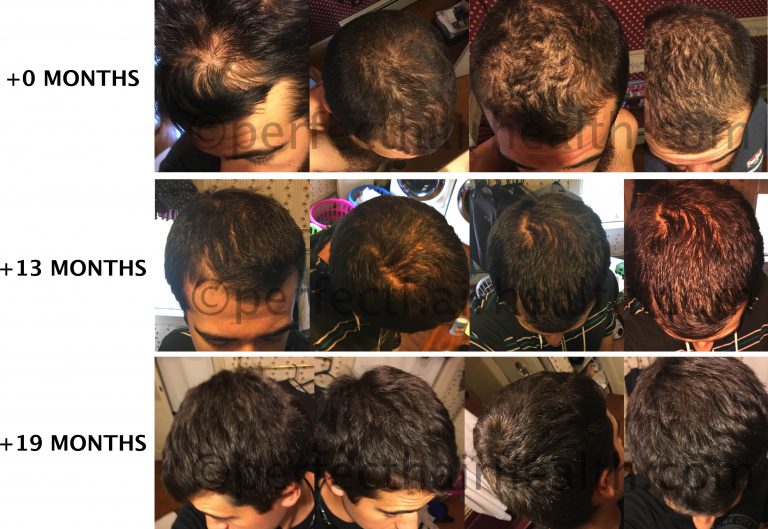 Do Scalp Massages Improve Hair Loss (AGA)? Our 2019 Study Results Do Scalp Massages Improve Hair Loss (AGA)? Our 2019 Study Results