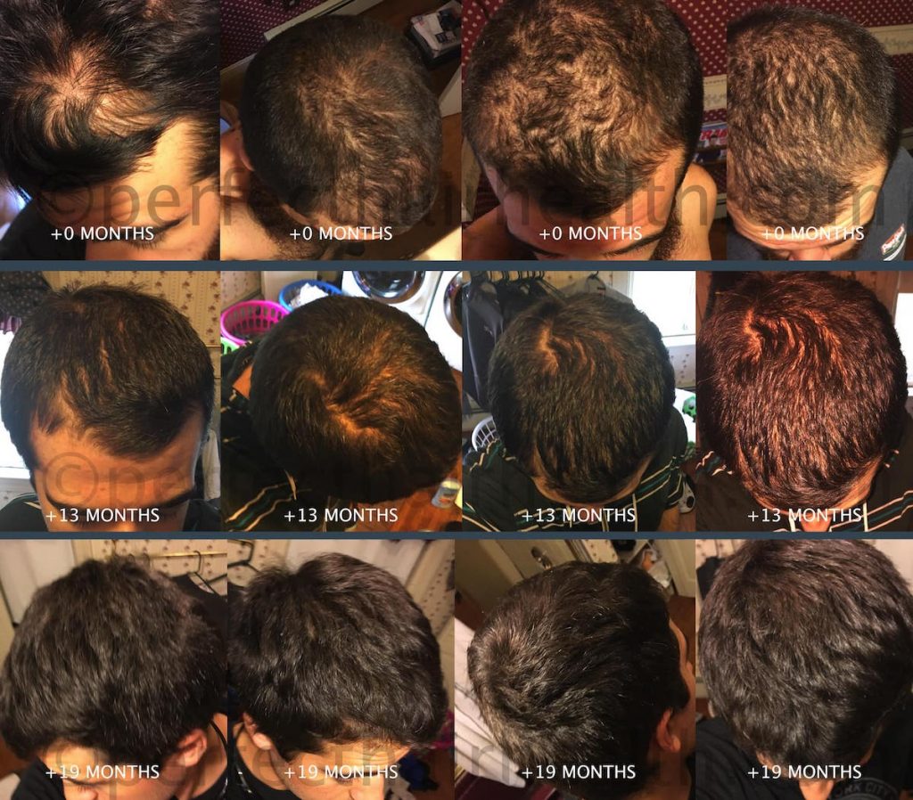 Diffuse Thinning: Causes, Implications, & Steps For Regrowth (Photos)