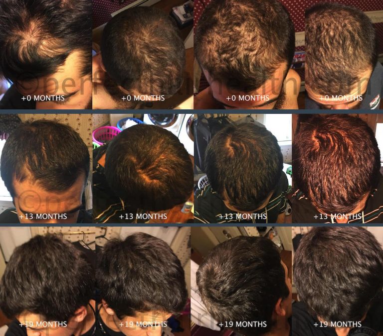Diffuse Thinning: Causes, Implications, & Steps For Regrowth (Photos)