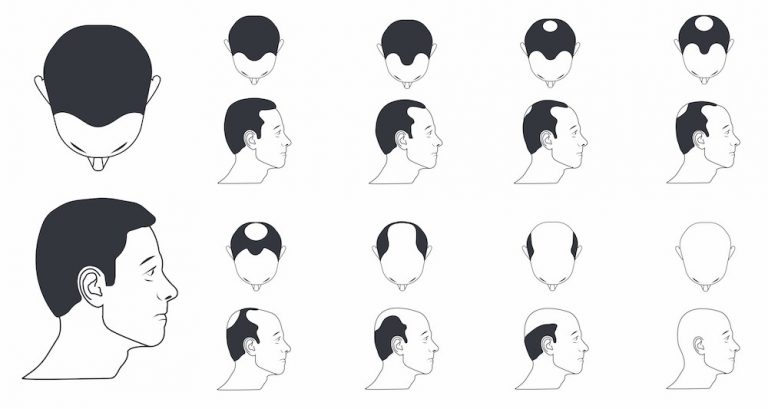 Androgenic Alopecia (AGA): What is it, Its Characteristics, Causes, And ...