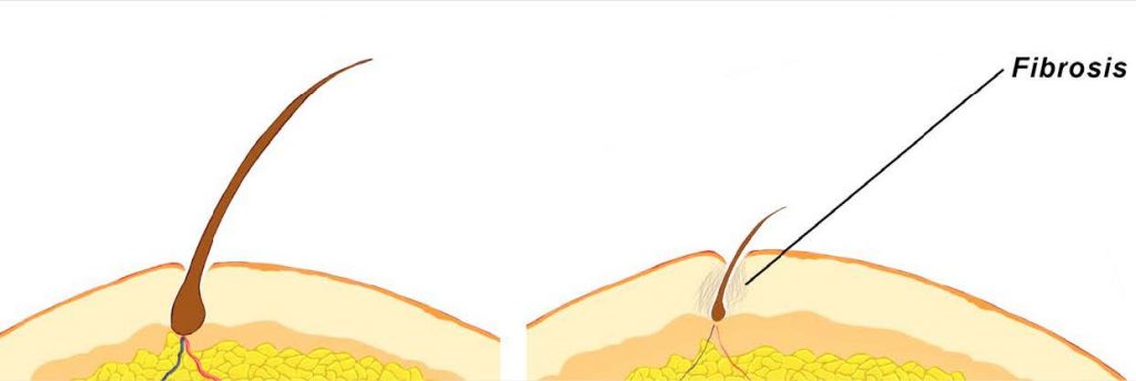 Androgenic Alopecia (AGA): What is it, Its Characteristics, Causes, And ...