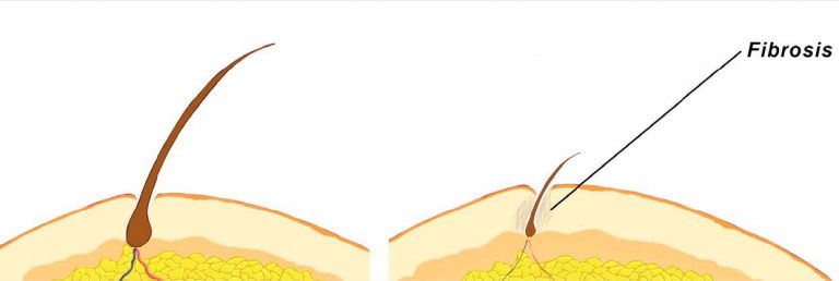 Androgenic Alopecia (AGA): What is it, Its Characteristics, Causes, And ...