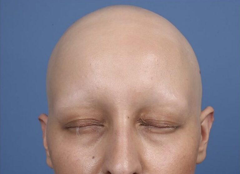 Alopecia Areata: Causes, Treatments, Breakthroughs | 2020 Guide