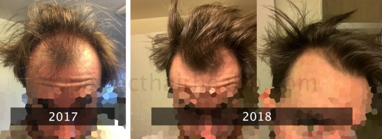 Stool Transplants & Accidental Hair Regrowth? Photos, Studies, & Science