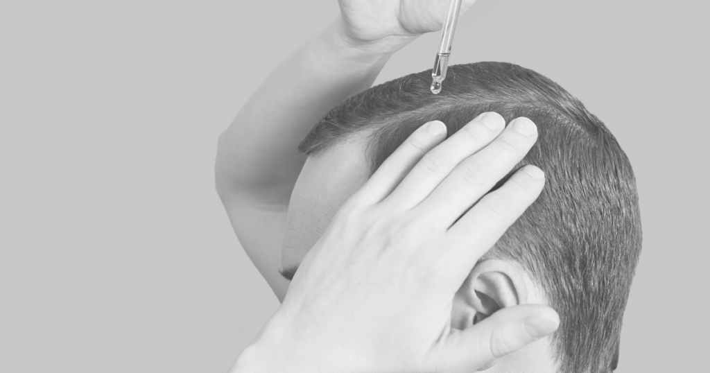 How Long After Stopping Minoxidil Does Hair Fall Out? - Perfect Hair Health How Long After Stopping Minoxidil Does Hair Fall Out? - Perfect Hair Health