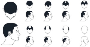 Mature Hairline vs Receding: How to Tell the Difference - Perfect Hair ...