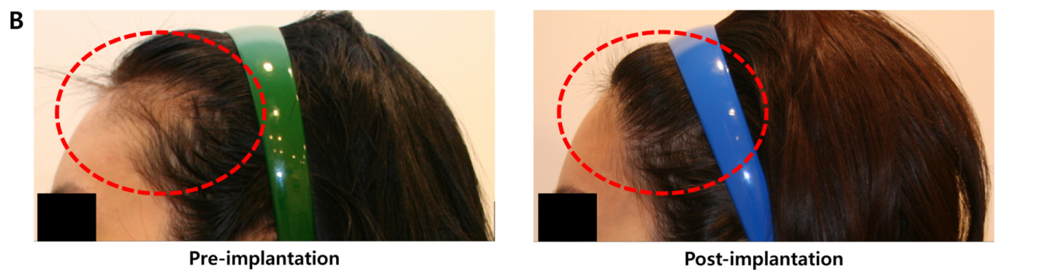 PDO Hair Treatment: Examining Threads of Evidence - Perfect Hair Health