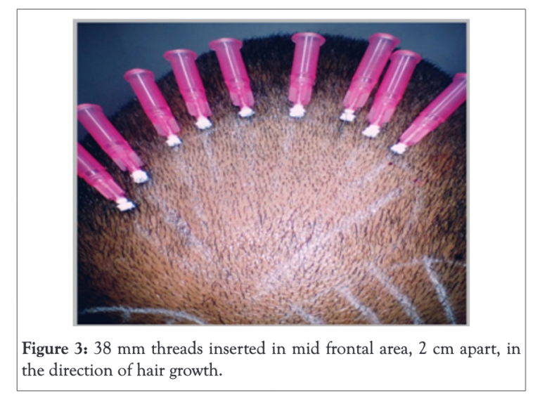 PDO Hair Treatment: Examining Threads of Evidence - Perfect Hair Health