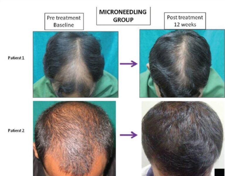 Microneedling For Hair Growth: Am I Supposed To Bleed?