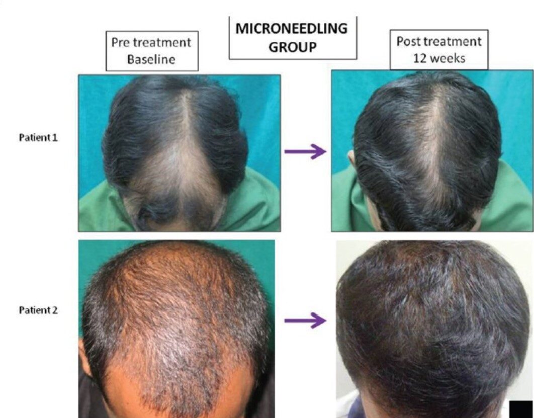 Microneedling For Hair Growth: Am I Supposed To Bleed?