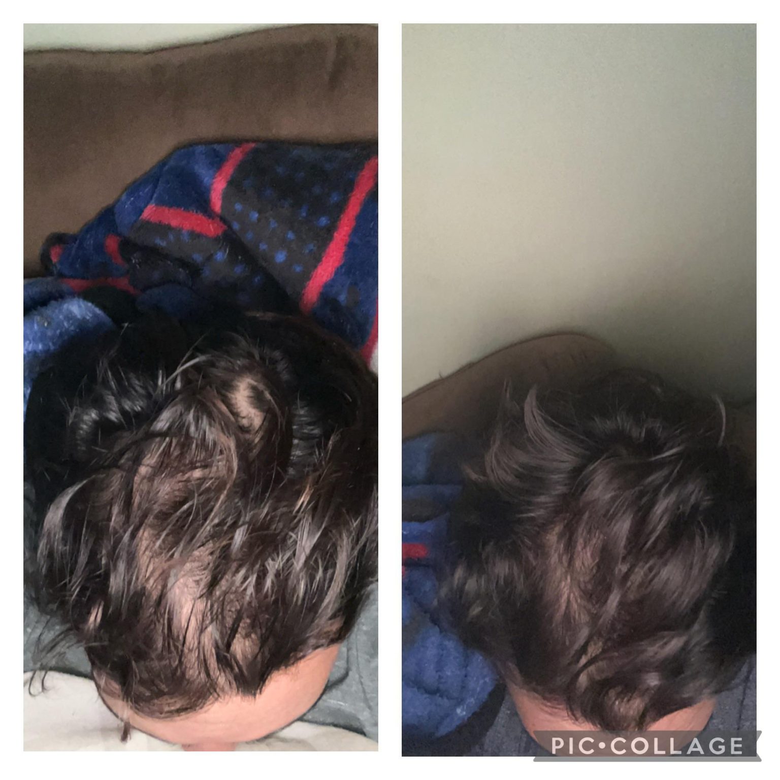 Dutasteride Before and After: 10 Success Stories