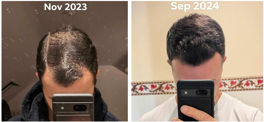Dutasteride Before and After: 10 Success Stories