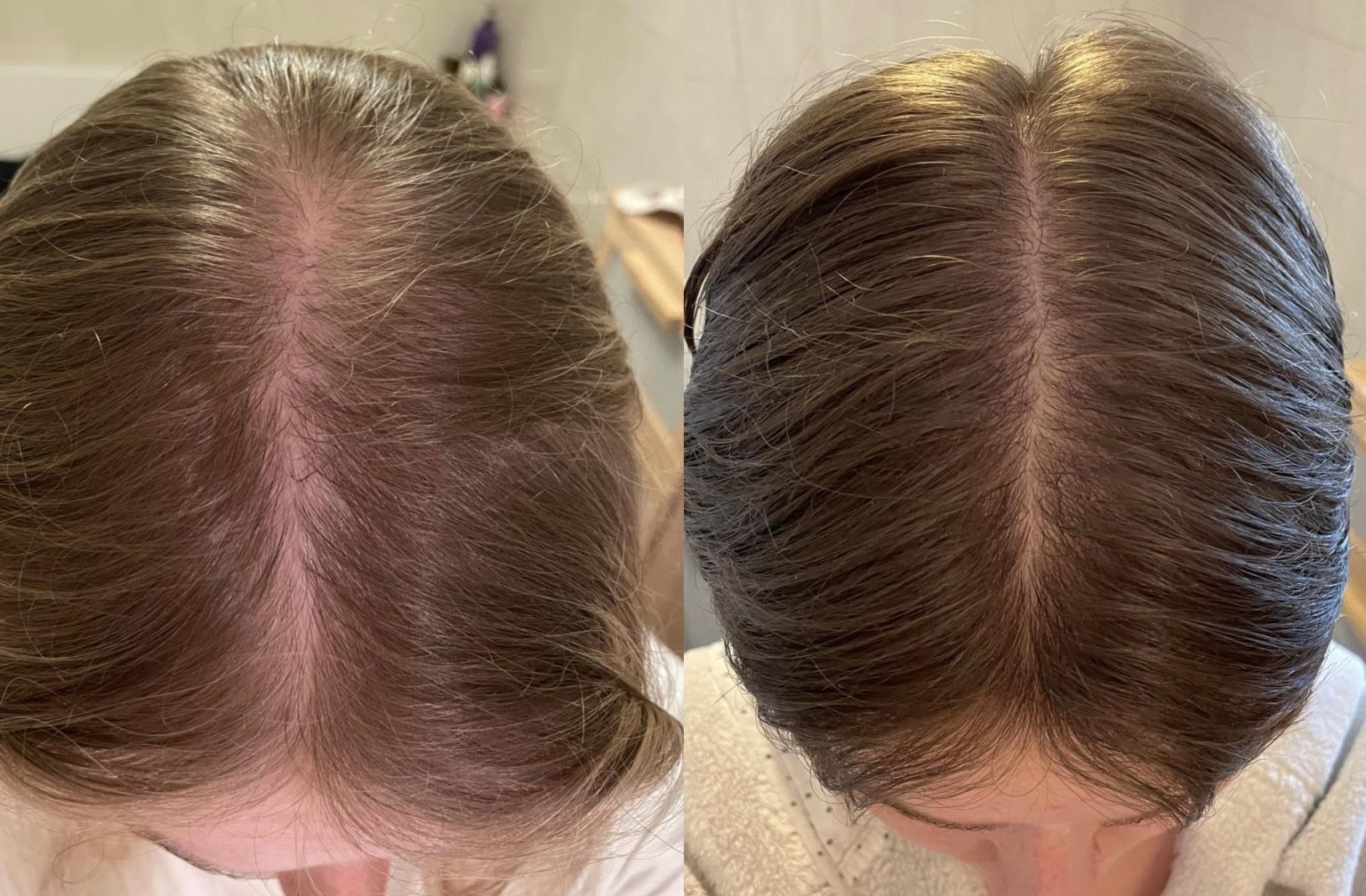 Dutasteride Before and After: 10 Success Stories