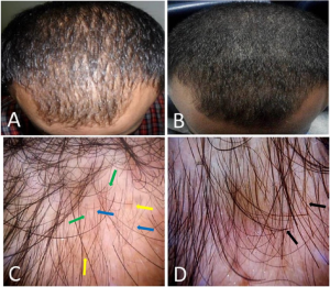 Does Topical Dutasteride Work? - Perfect Hair Health