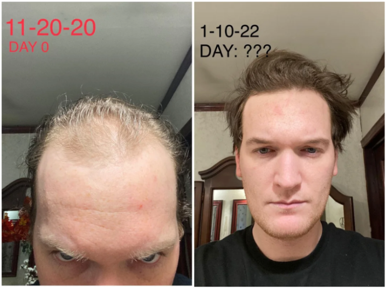 Oral Finasteride Before and After: Real Case Studies