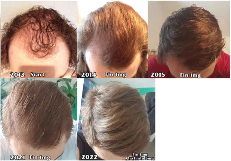 Oral Finasteride Before and After: Real Case Studies