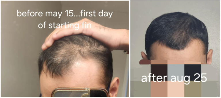 Oral Finasteride Before and After: Real Case Studies