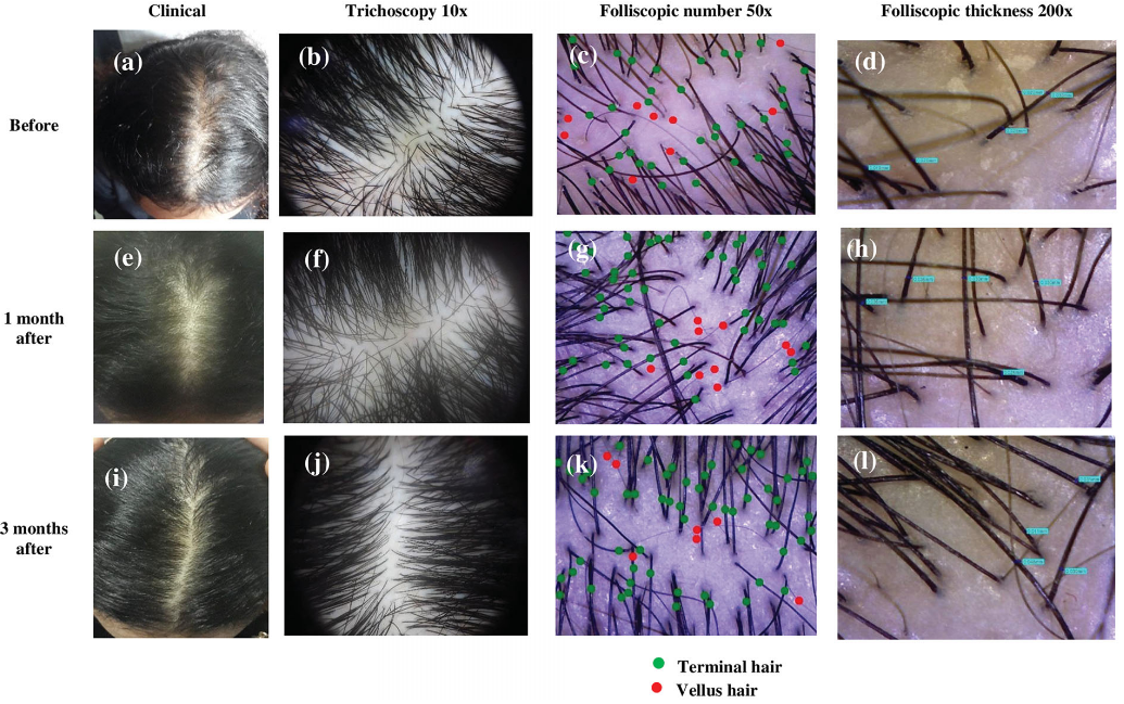 Topical & Mesotherapy Dutasteride: Evidence, Dosing, Safety