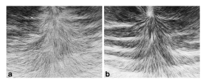 RU58841 for Hair Loss: Is It Legit?