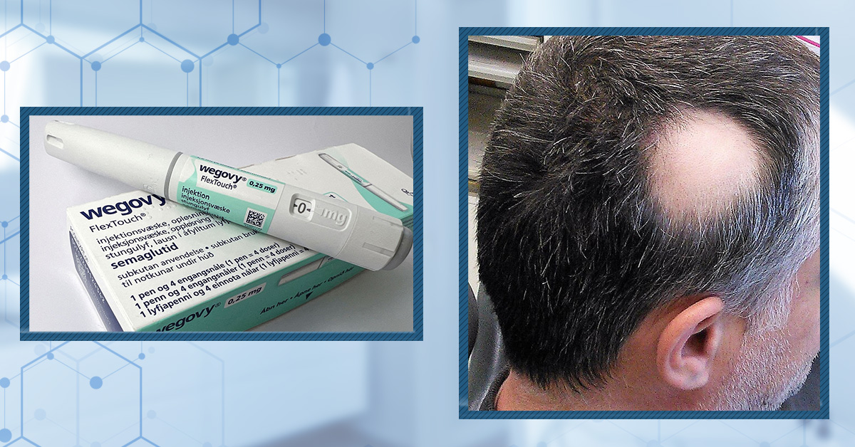 Does Wegovy Cause Hair Loss?